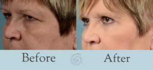 Eyelid Surgery Before and After - Pittman Plastic Surgery