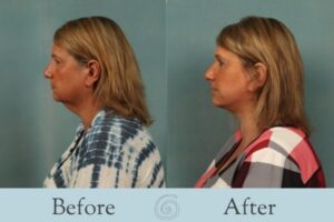 Facelift Before and After - Pittman Plastic Surgery - Athens Georgia