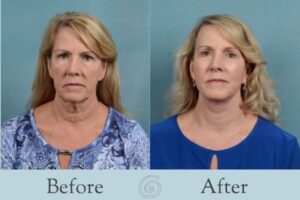 Facelift Athens GA - Necklift | Pittman Plastic Surgery