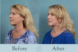 Facelift Before and After - Pittman Plastic Surgery - Athens Georgia