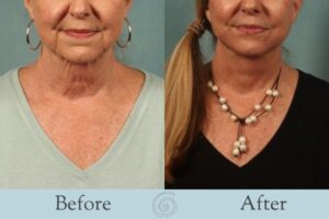 Facelift Athens GA - Necklift | Pittman Plastic Surgery