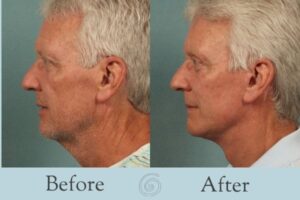 Facelift Before and After - Pittman Plastic Surgery - Athens Georgia