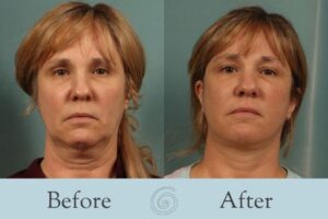 Facelift Before and After - Pittman Plastic Surgery - Athens Georgia