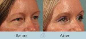 Eyelid Surgery Before and After - Pittman Plastic Surgery