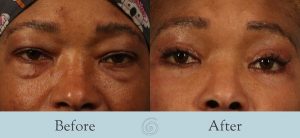 Eyelid Surgery Before and After - Pittman Plastic Surgery