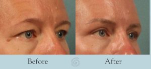 Eyelid Surgery Before and After - Pittman Plastic Surgery
